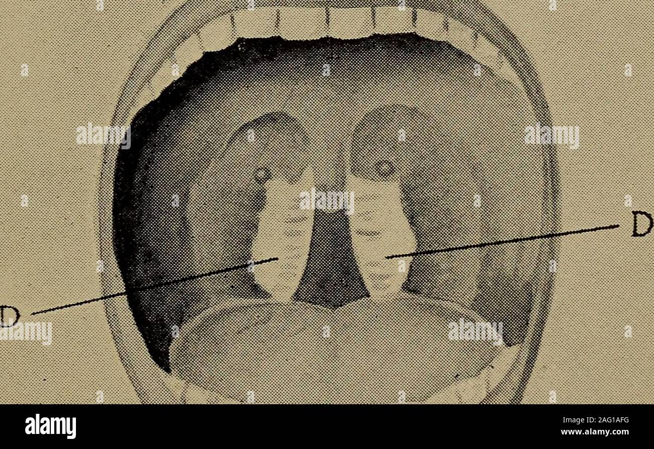 . Diseases of infancy and childhood. S I J. JL, Top—Follicular ...