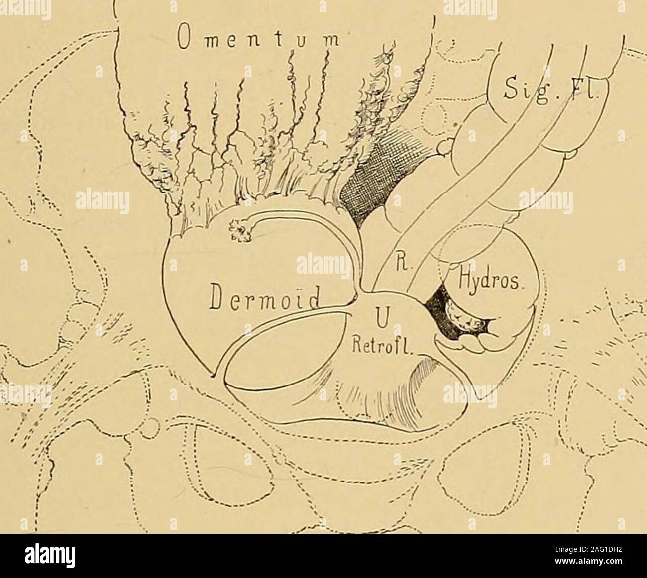 . Operative gynecology. Fig. 422.—Left Dermoid Cyst of theOvary with a ...