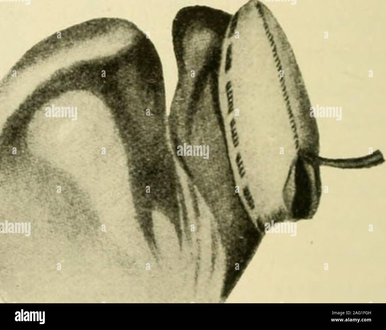 . Manual of operative surgery. Fig. 689. Fig. 690. Figs. 689 and 690 ...