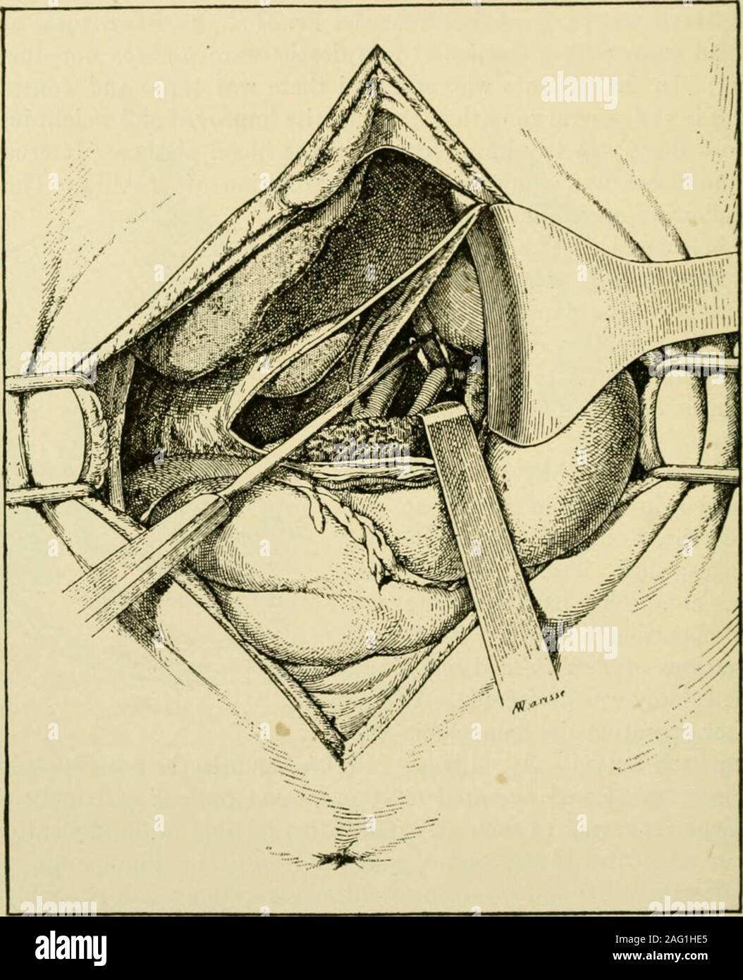 Epigastrium hi-res stock photography and images - Alamy
