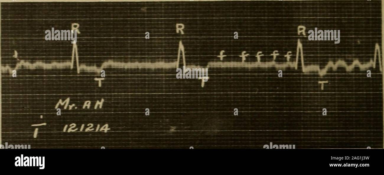 Ventricular rate hi-res stock photography and images - Alamy