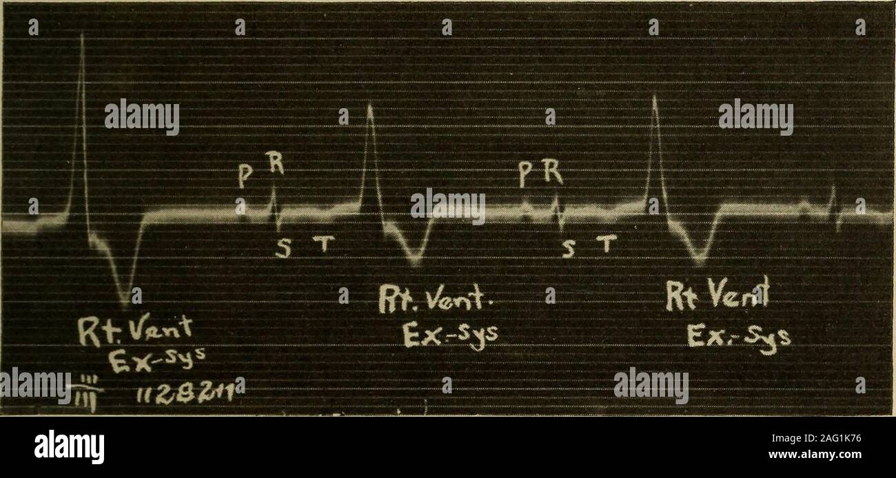 Extrasystole hi-res stock photography and images - Alamy