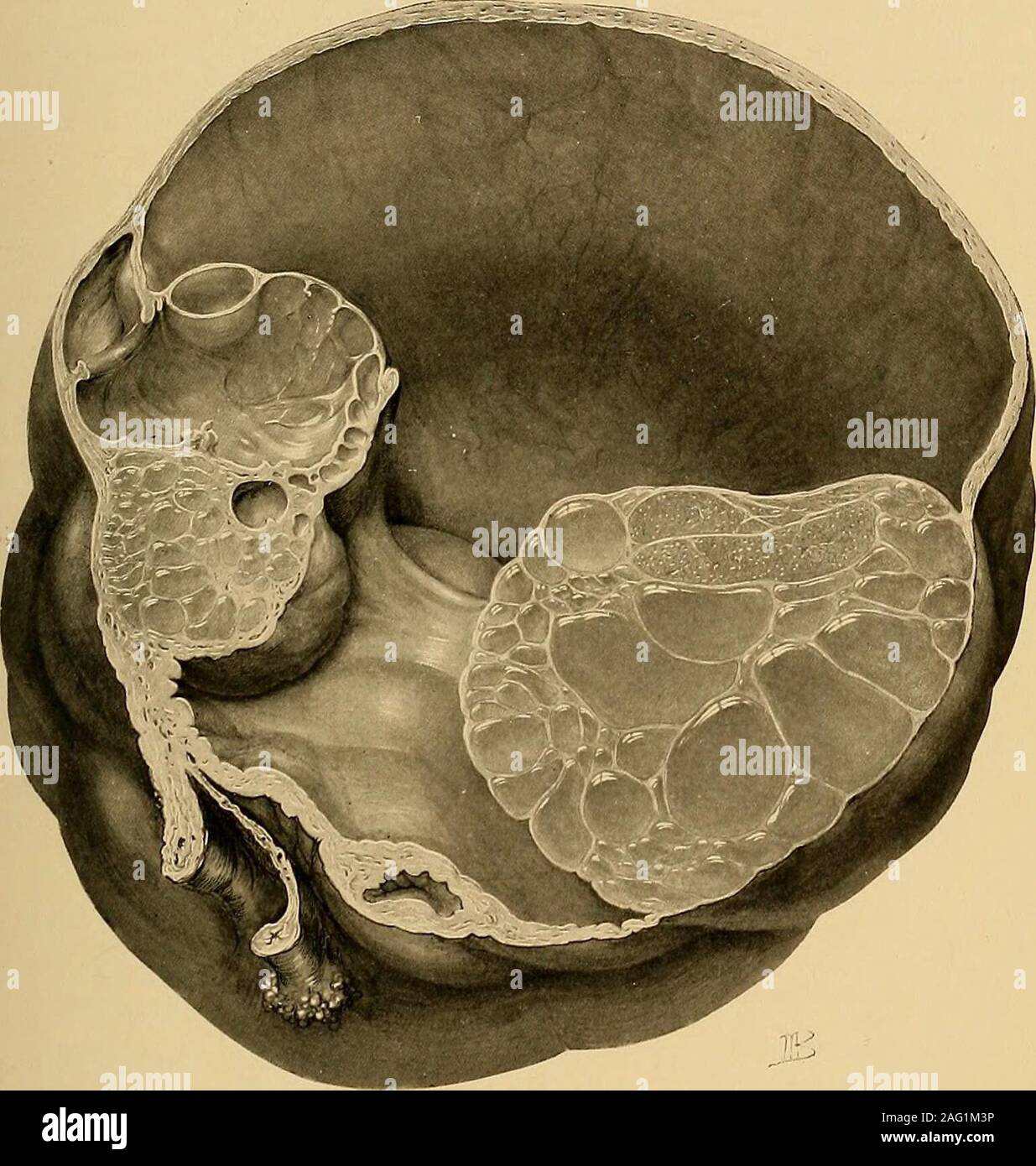 Fluid cysts hi-res stock photography and images - Alamy