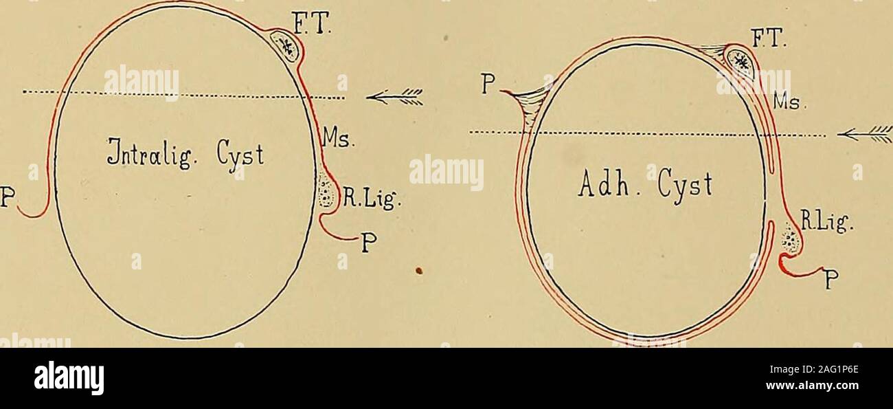 . Operative gynecology. ind theuterus is found lying closely attached ...