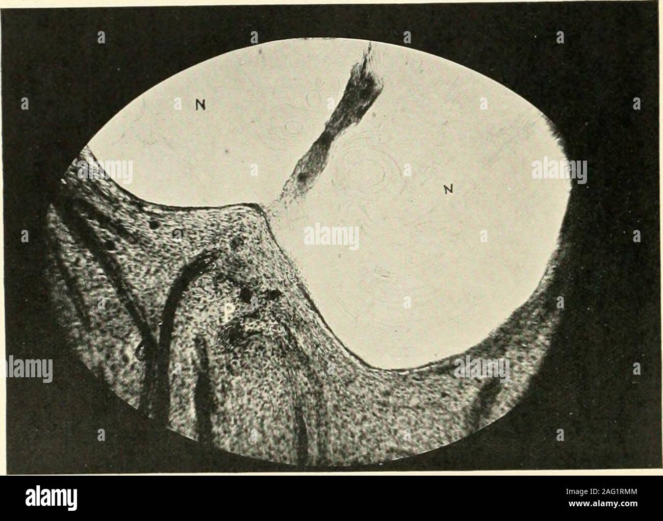 Surgery blood pulp hi-res stock photography and images - Alamy