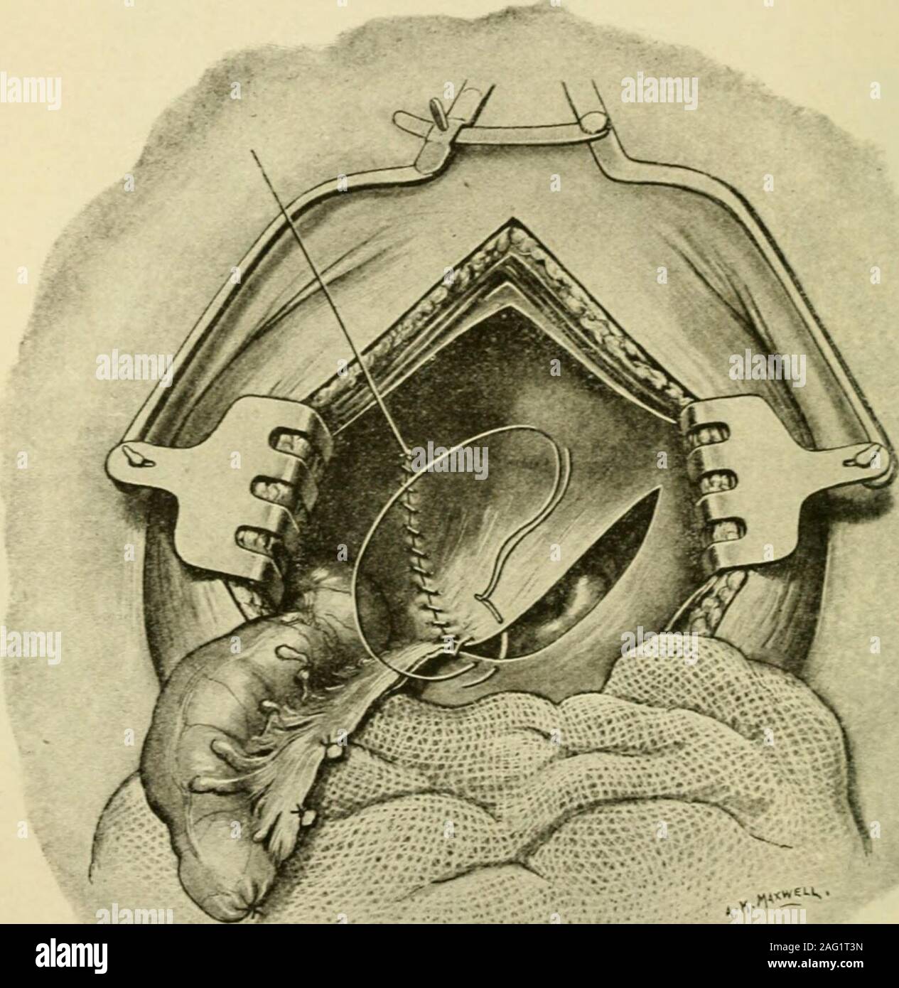 Parietal peritoneum hi-res stock photography and images - Alamy