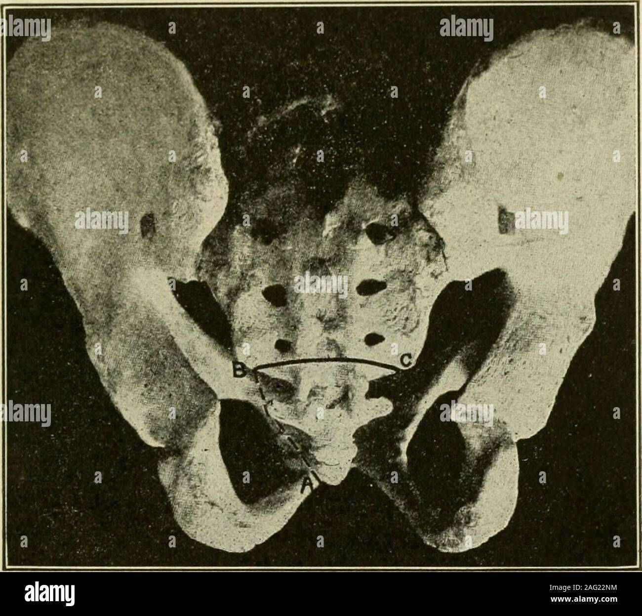 Faecal fistula hi-res stock photography and images - Alamy