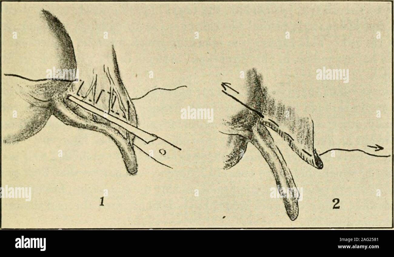 Mesoappendix hi-res stock photography and images - Alamy