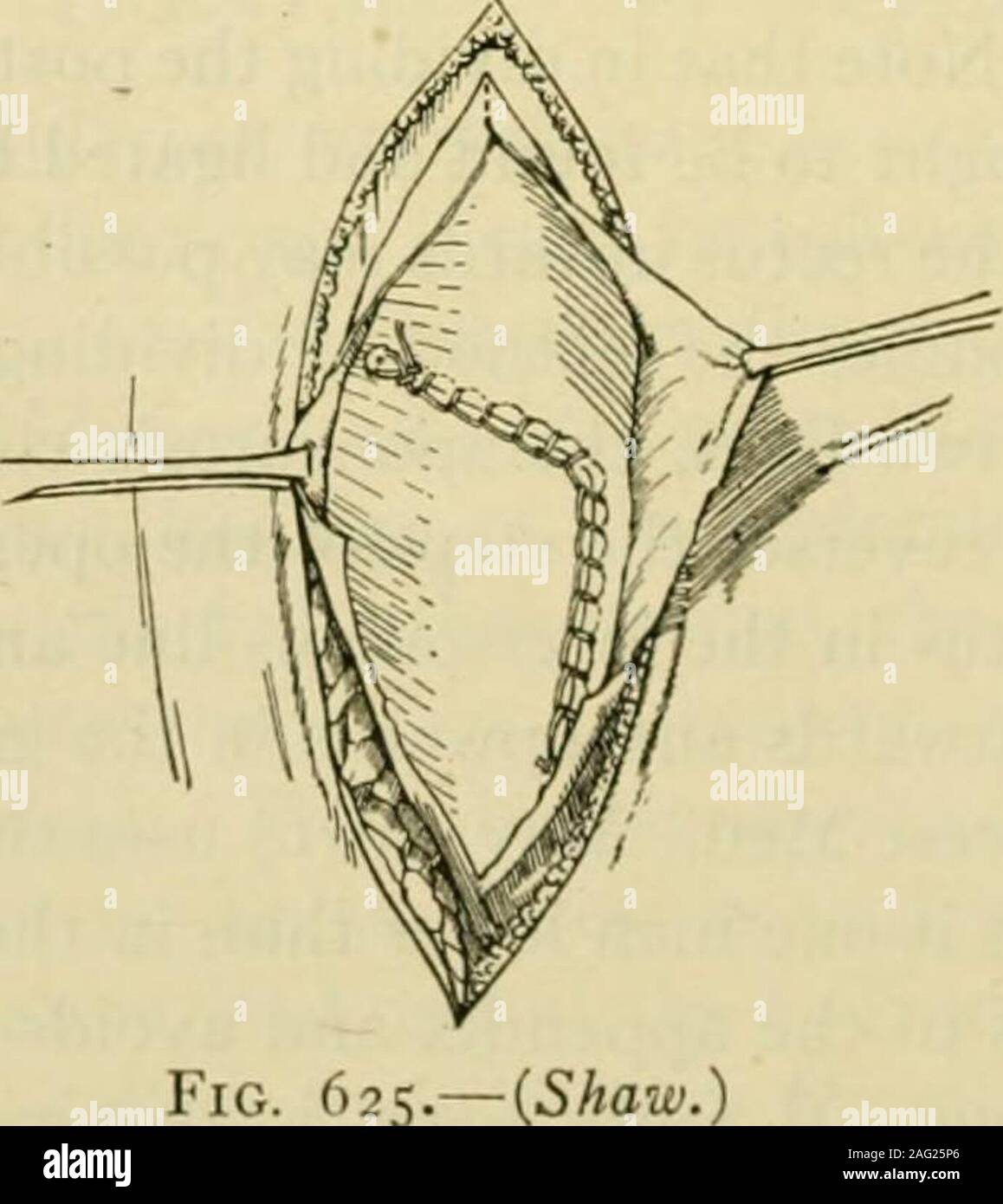 . Manual of operative surgery. Fig. 623.—(S/iaw.) Fig. 624.—(Shaw.) (C ...