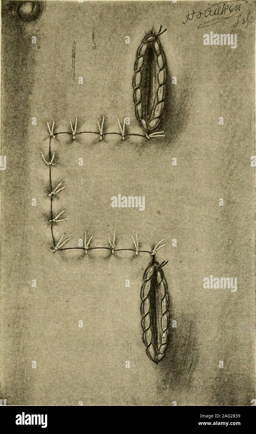 . Manual of operative surgery. ectus acts as a sphincter. Through the ...