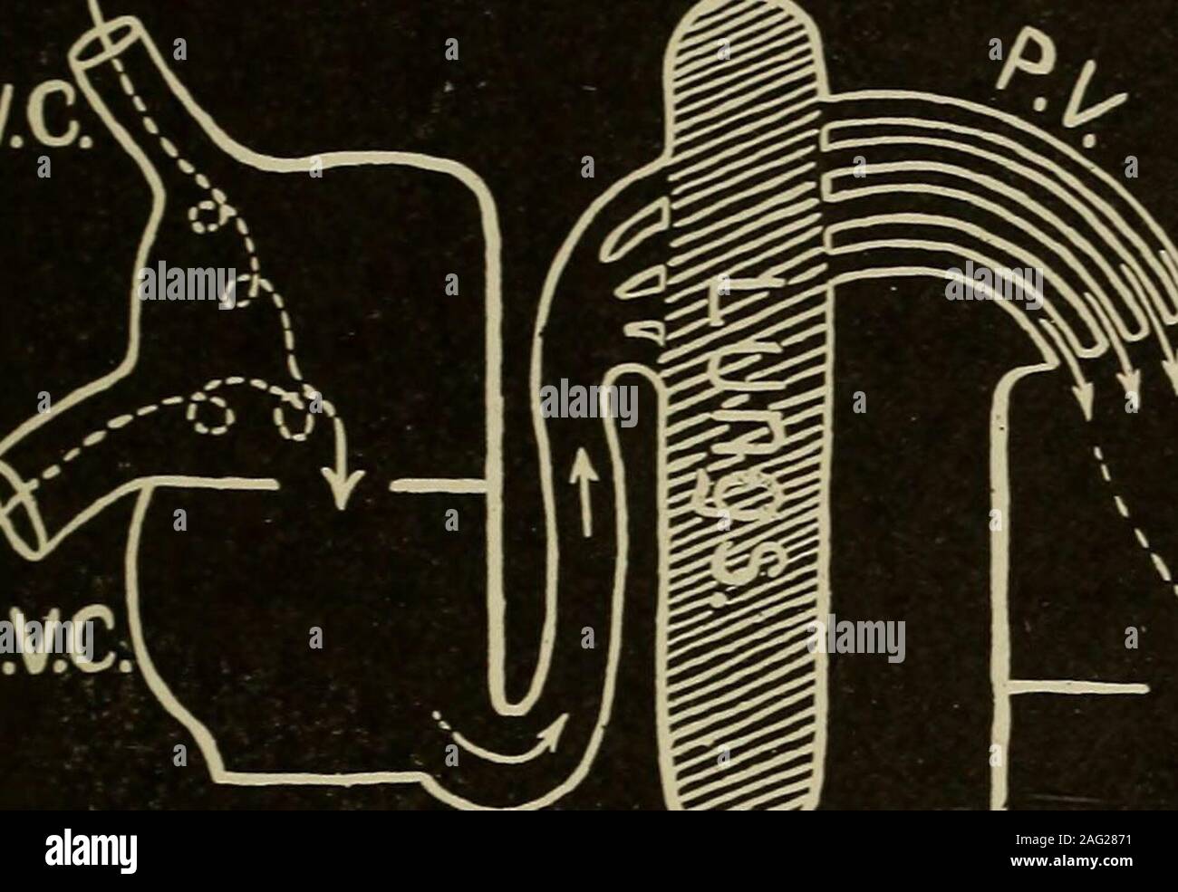 Subcutaneous air hi-res stock photography and images - Alamy