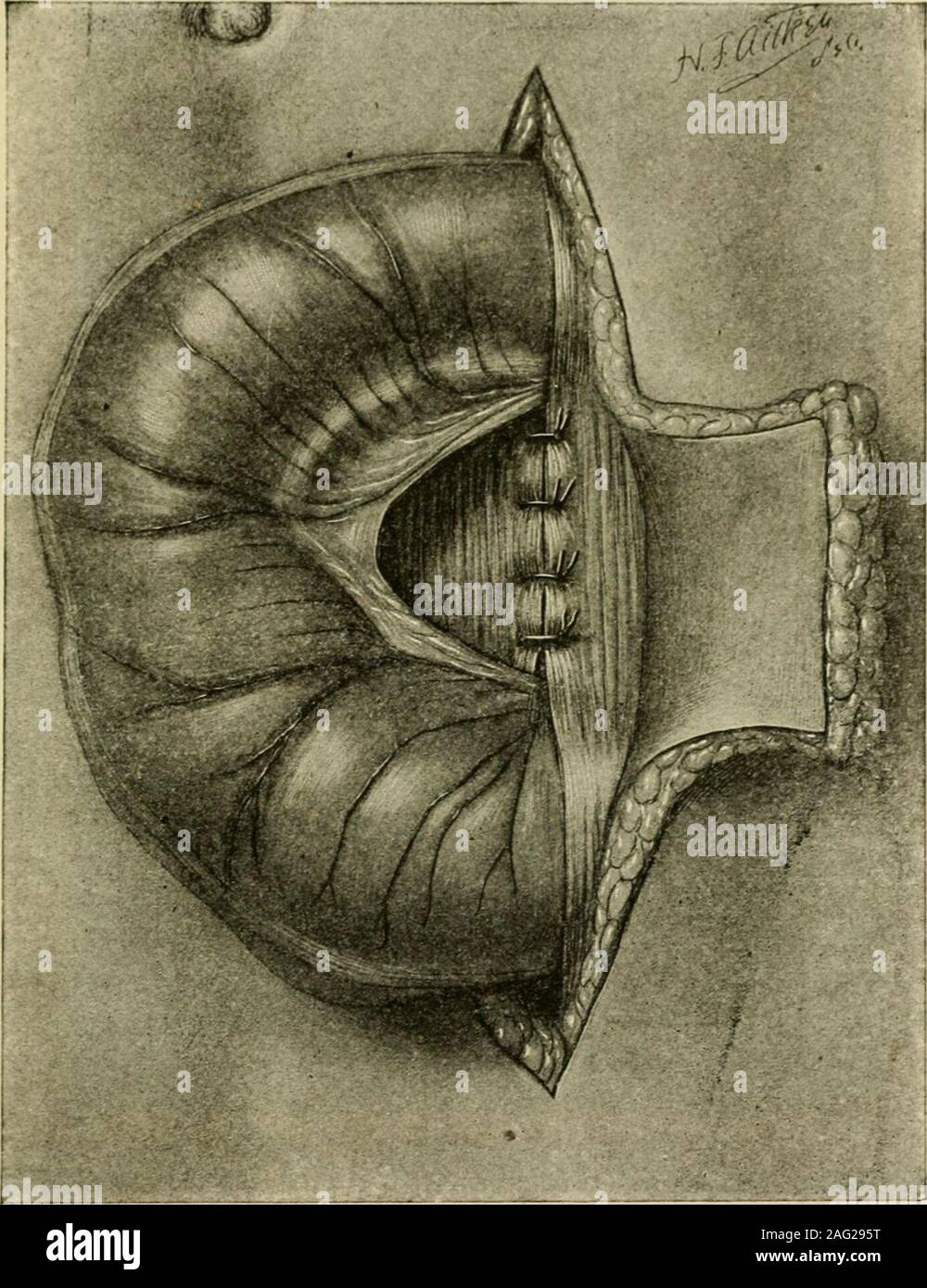 . Manual of operative surgery. FlG. 614. -JMixters anterior colostomy ...