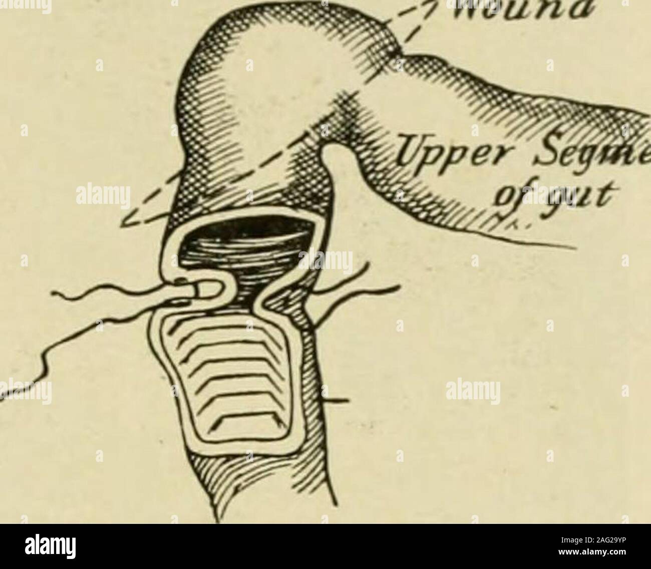 Purse string sutures hi-res stock photography and images - Alamy