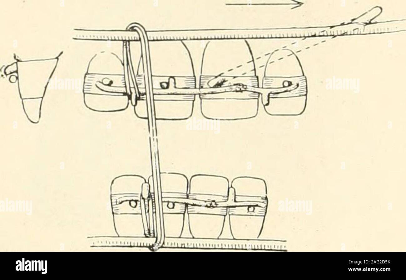 . The science and practice of dental surgery. KiG. 311.—Shows the wire ...