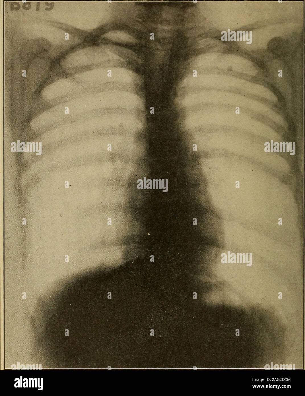 Suprasternal notch hi-res stock photography and images - Alamy