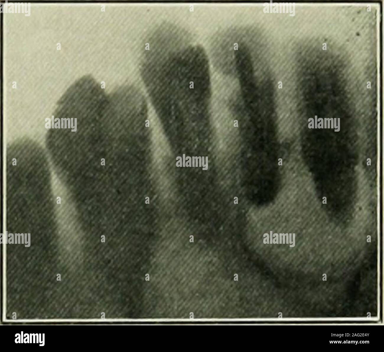 . Dental electro-therapeutics. Abscess on lower molar showing ex ...