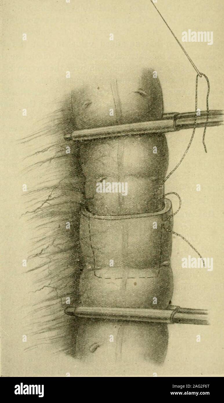 High ligation hi-res stock photography and images - Alamy