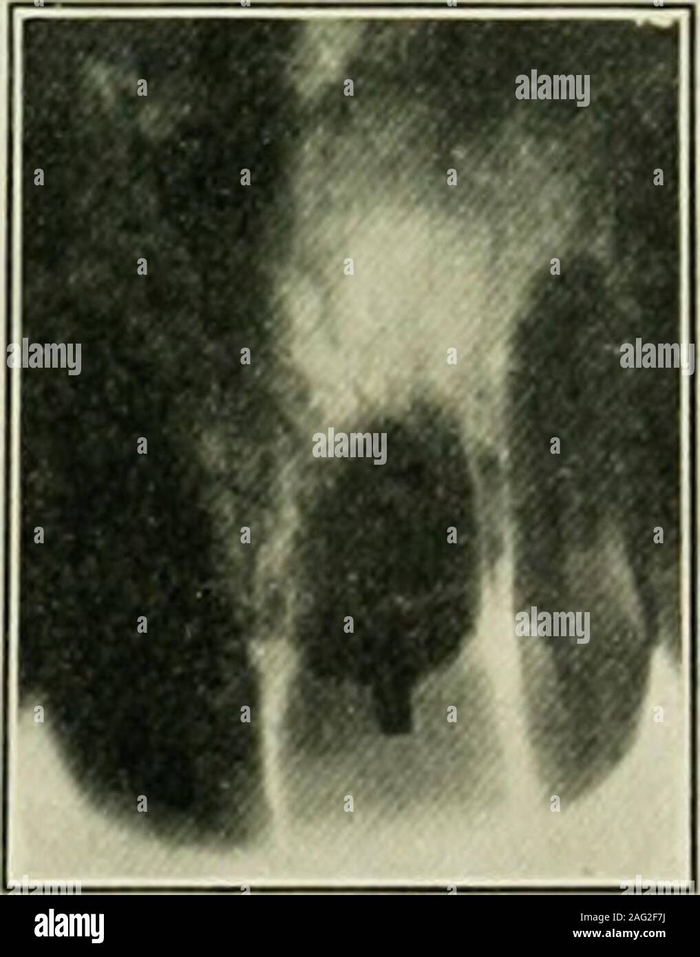 . Dental electro-therapeutics. Fig. 102. Case of fistula of right upper ...