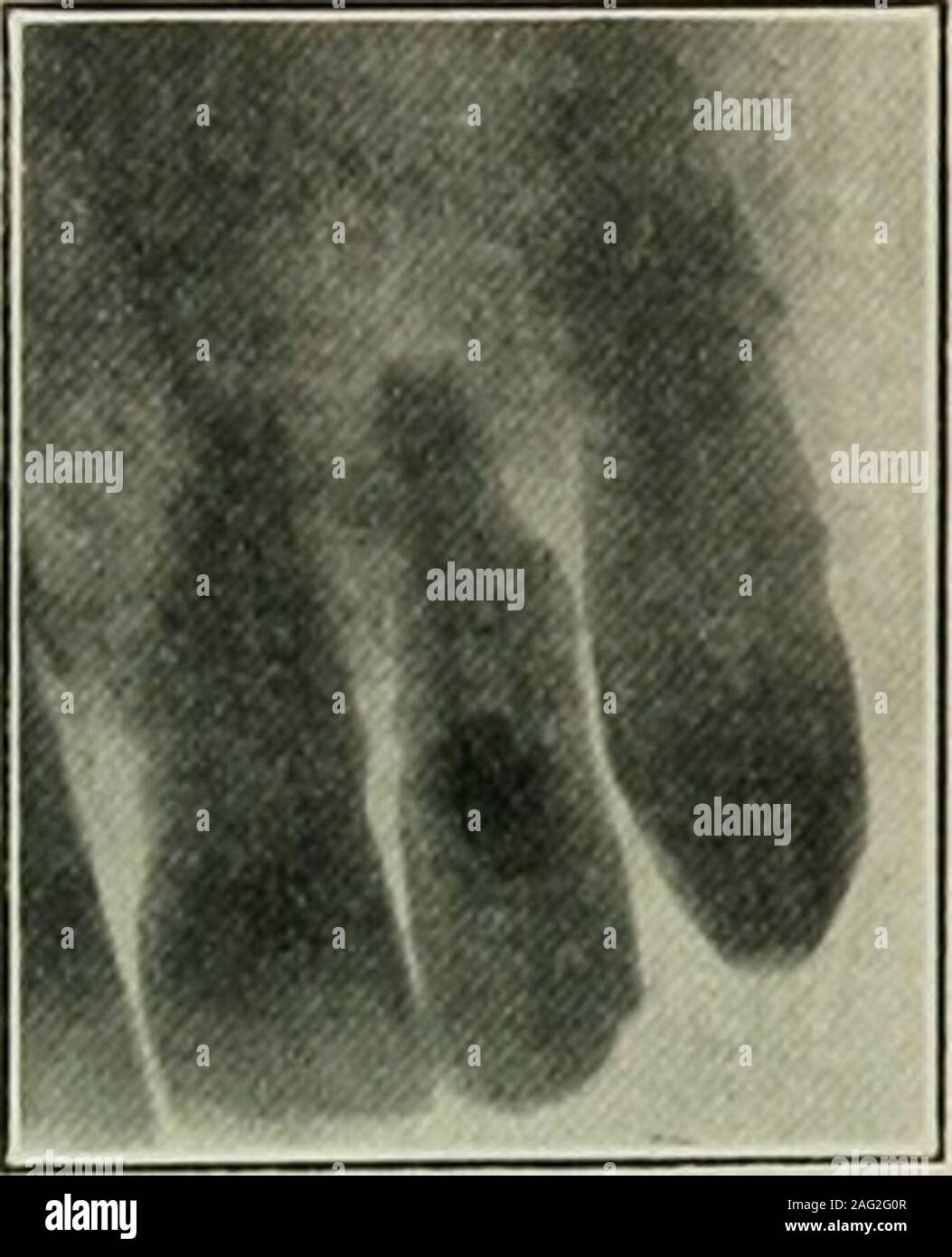 . Dental electro-therapeutics. Figs. 99 and 100. Cases of absorption in ...