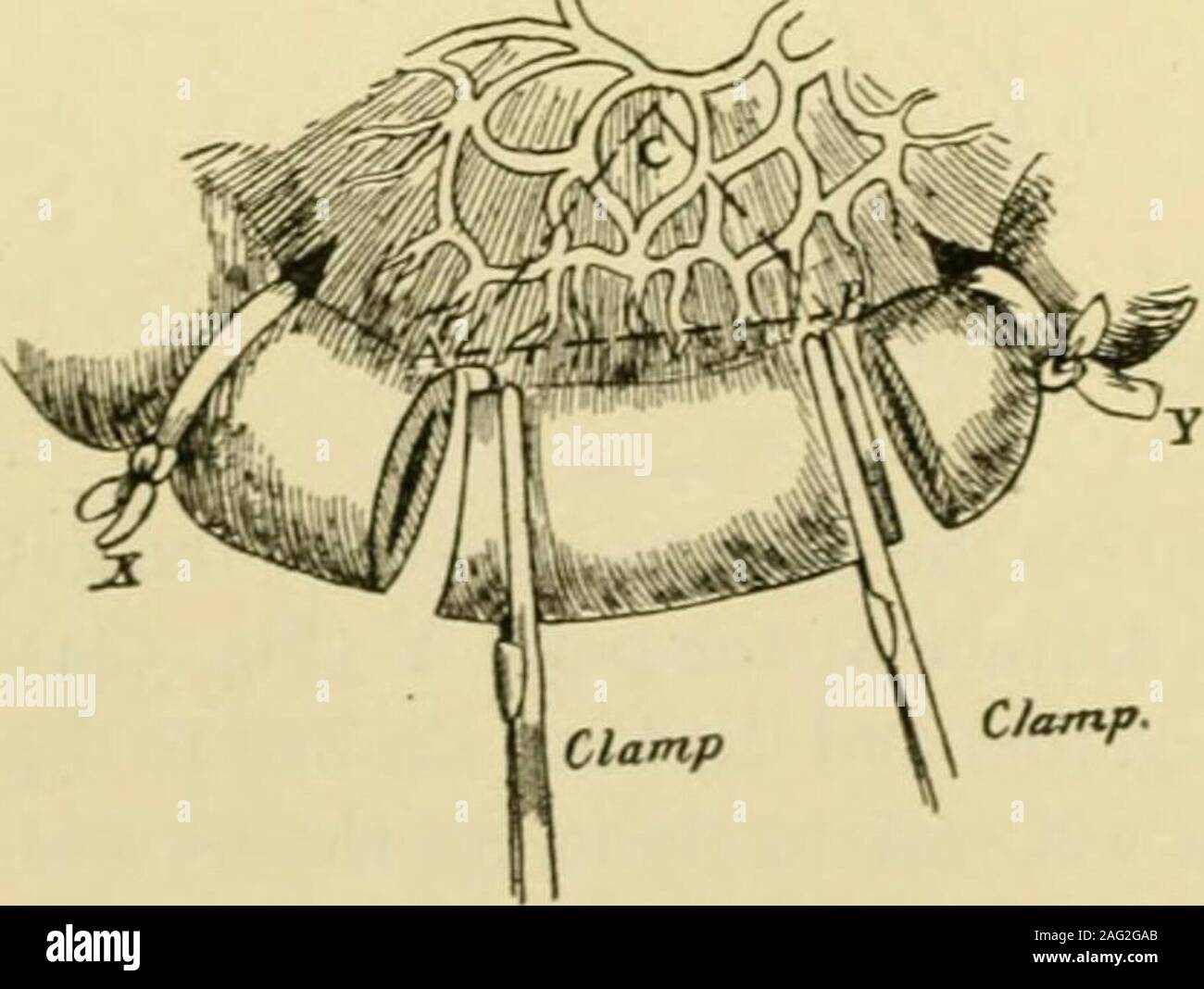 . Manual of operative surgery. Lateral anas-tomosis. G. Monaris uretero ...