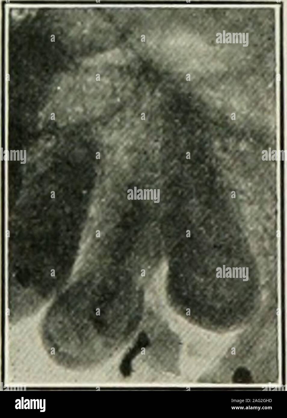 . Dental electro-therapeutics. Stereograph of right upper canine. Fig ...