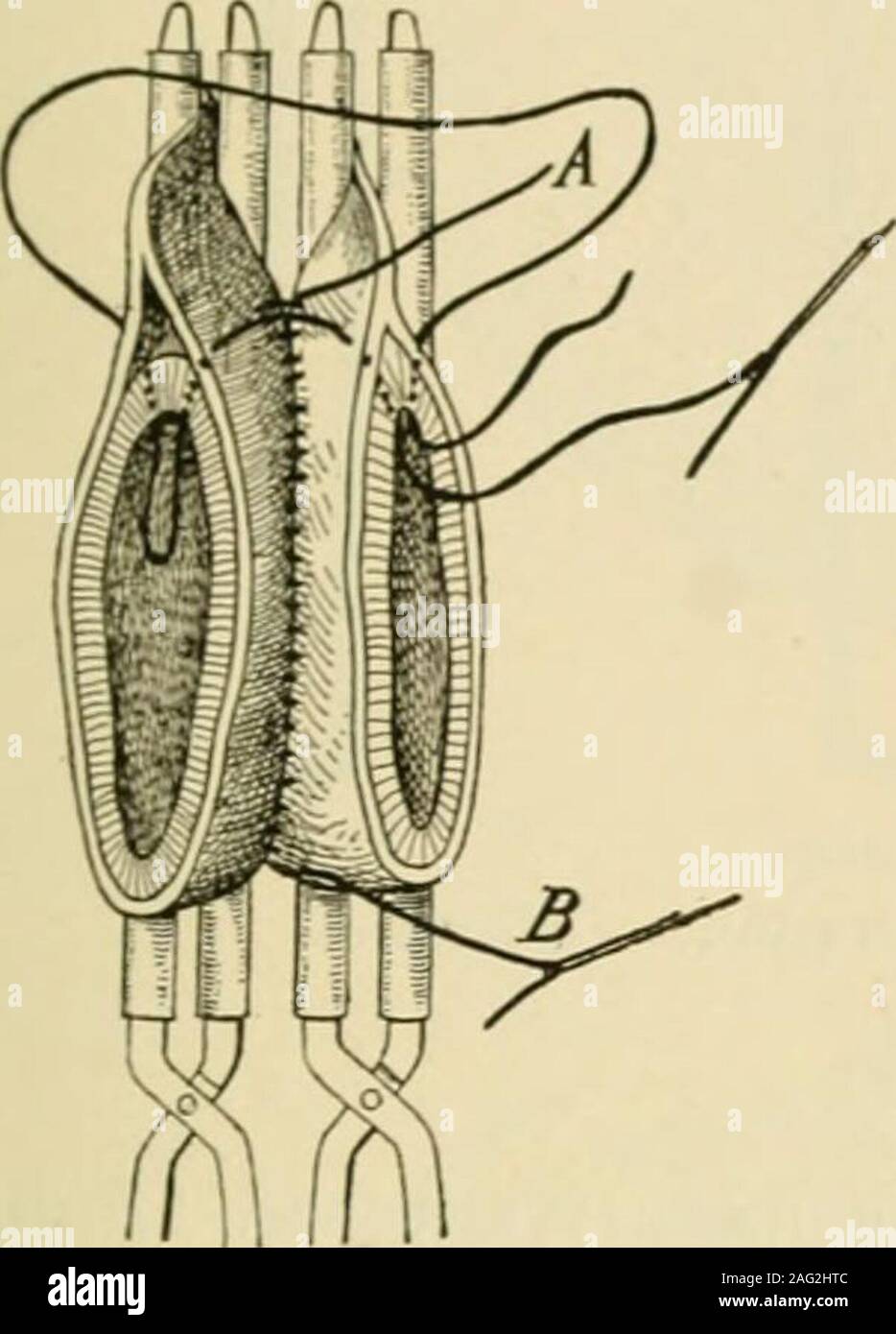 Side to side anastomosis hi-res stock photography and images - Alamy
