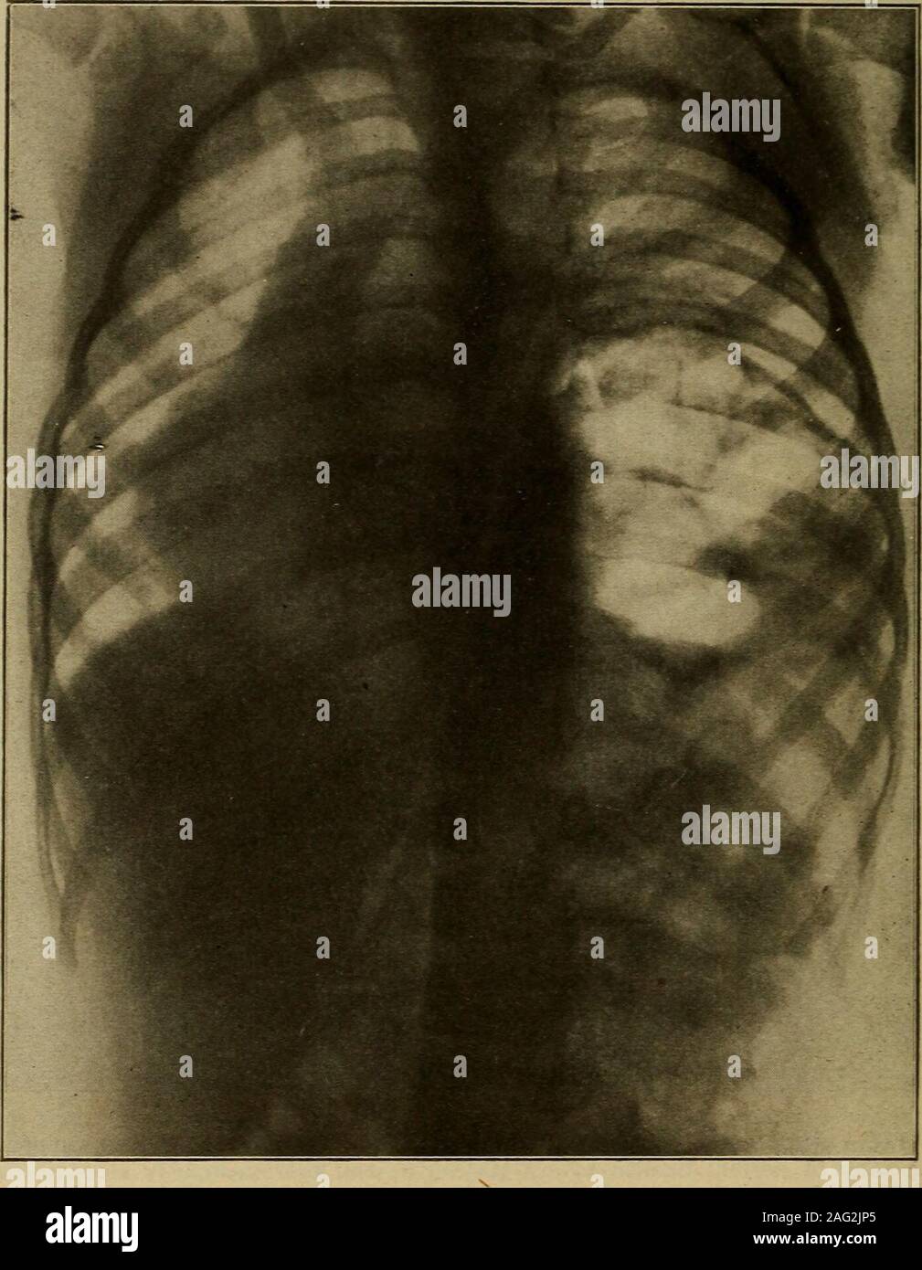 Modified thorax hi-res stock photography and images - Alamy