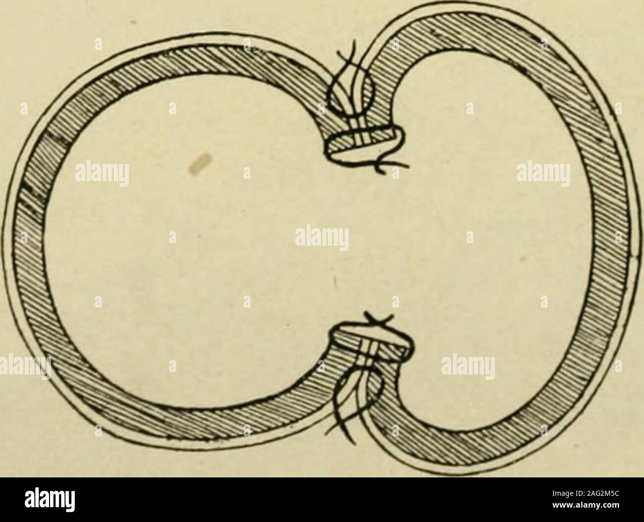 Anastomosis intestinal hi-res stock photography and images - Alamy