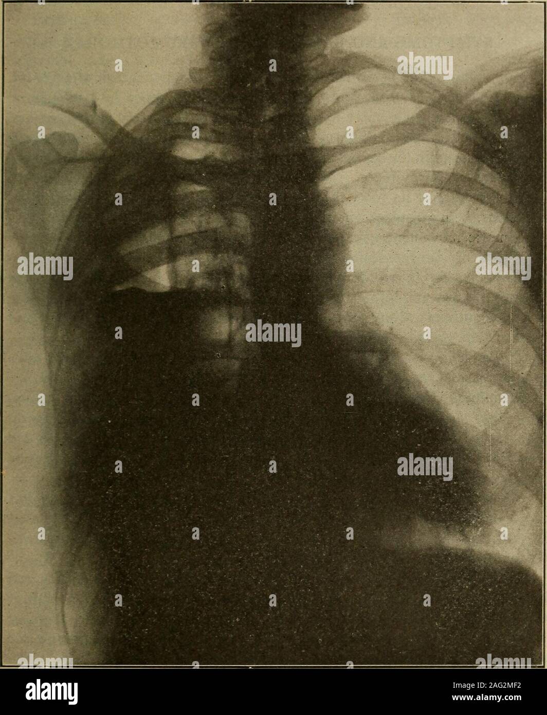 Pyopneumothorax hi-res stock photography and images - Alamy