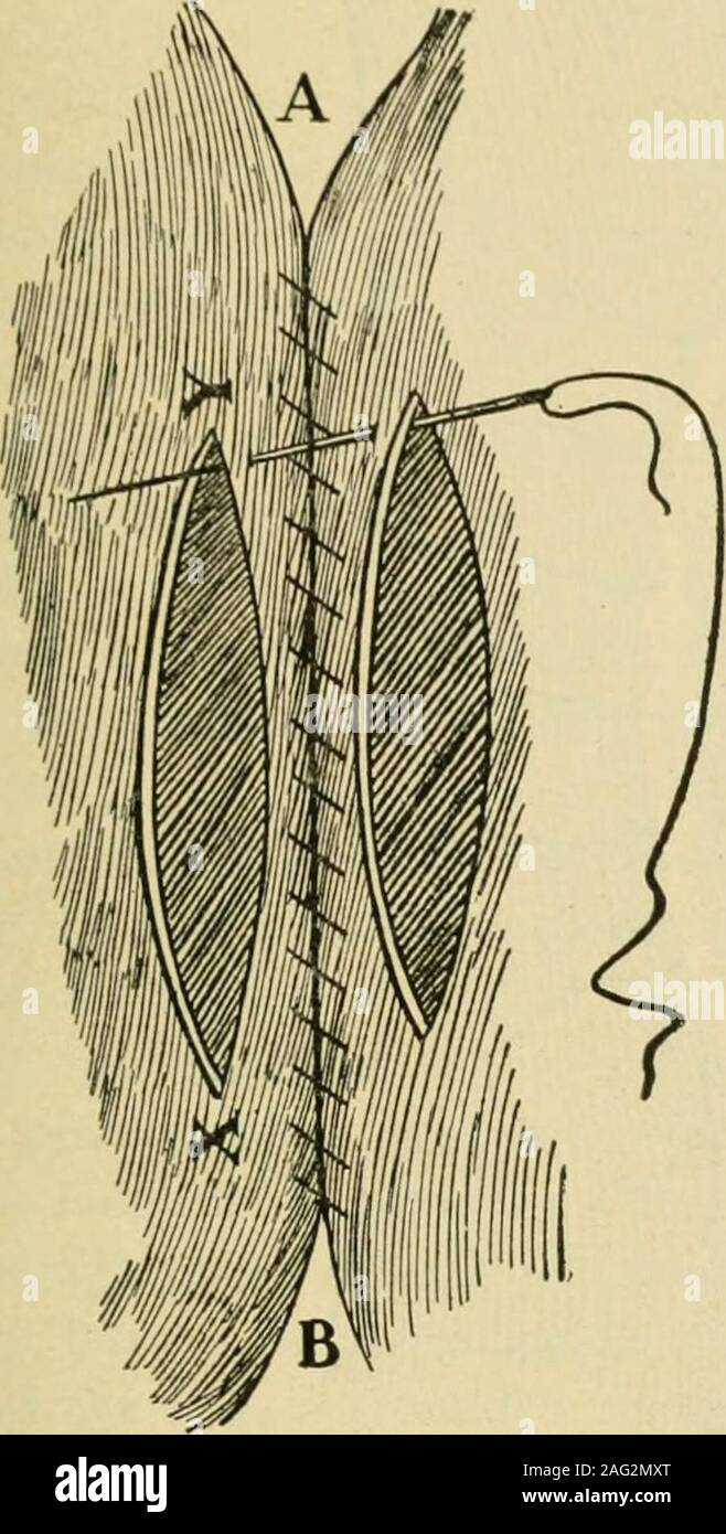. Manual of operative surgery. e other loop of gut. Step 4.—With a ...