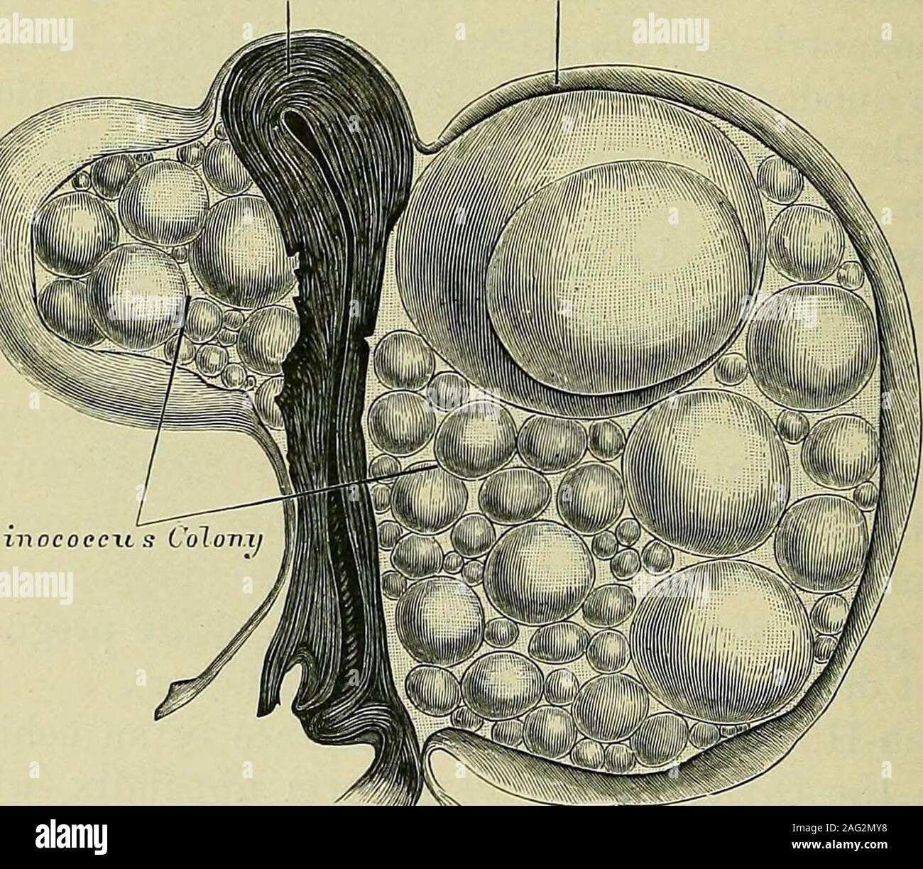 Hydrocele hi-res stock photography and images - Alamy