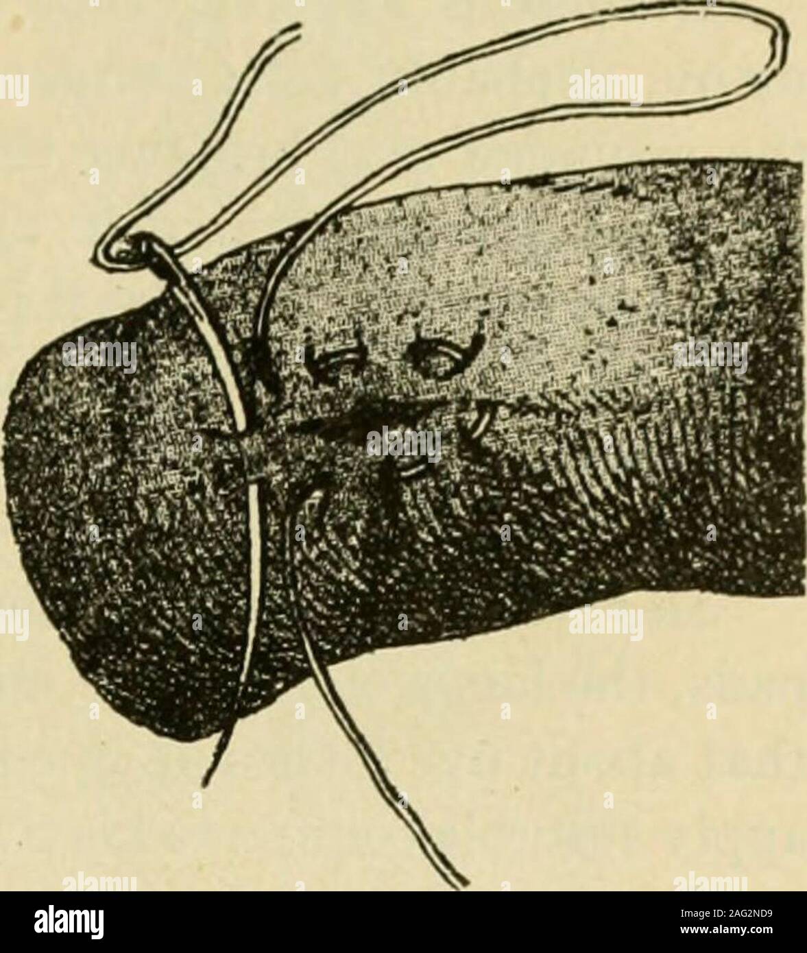 Intestinal perforation hi-res stock photography and images - Alamy
