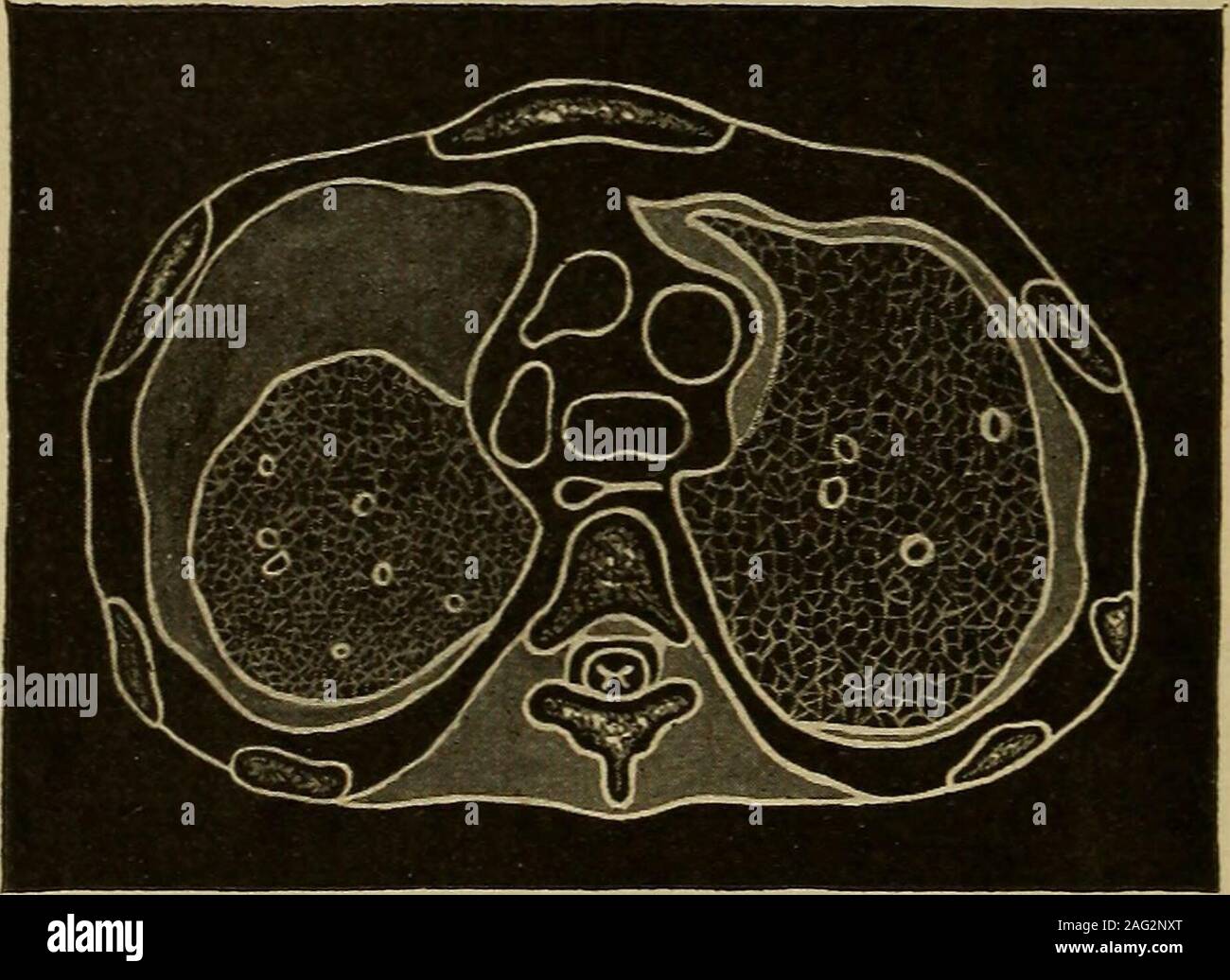 Pleural adhesion hi-res stock photography and images - Alamy