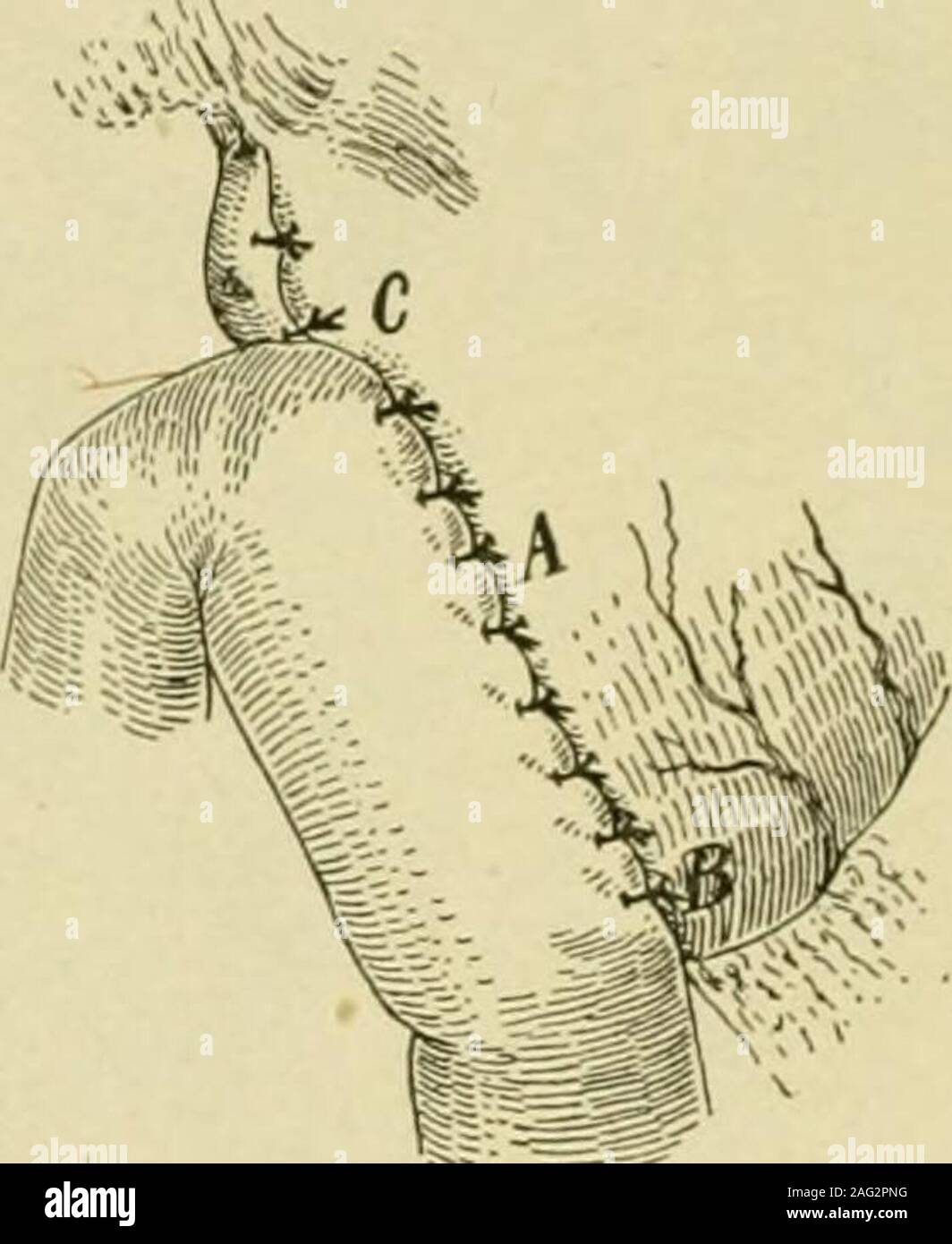 Pyloric lymph nodes hi-res stock photography and images - Alamy