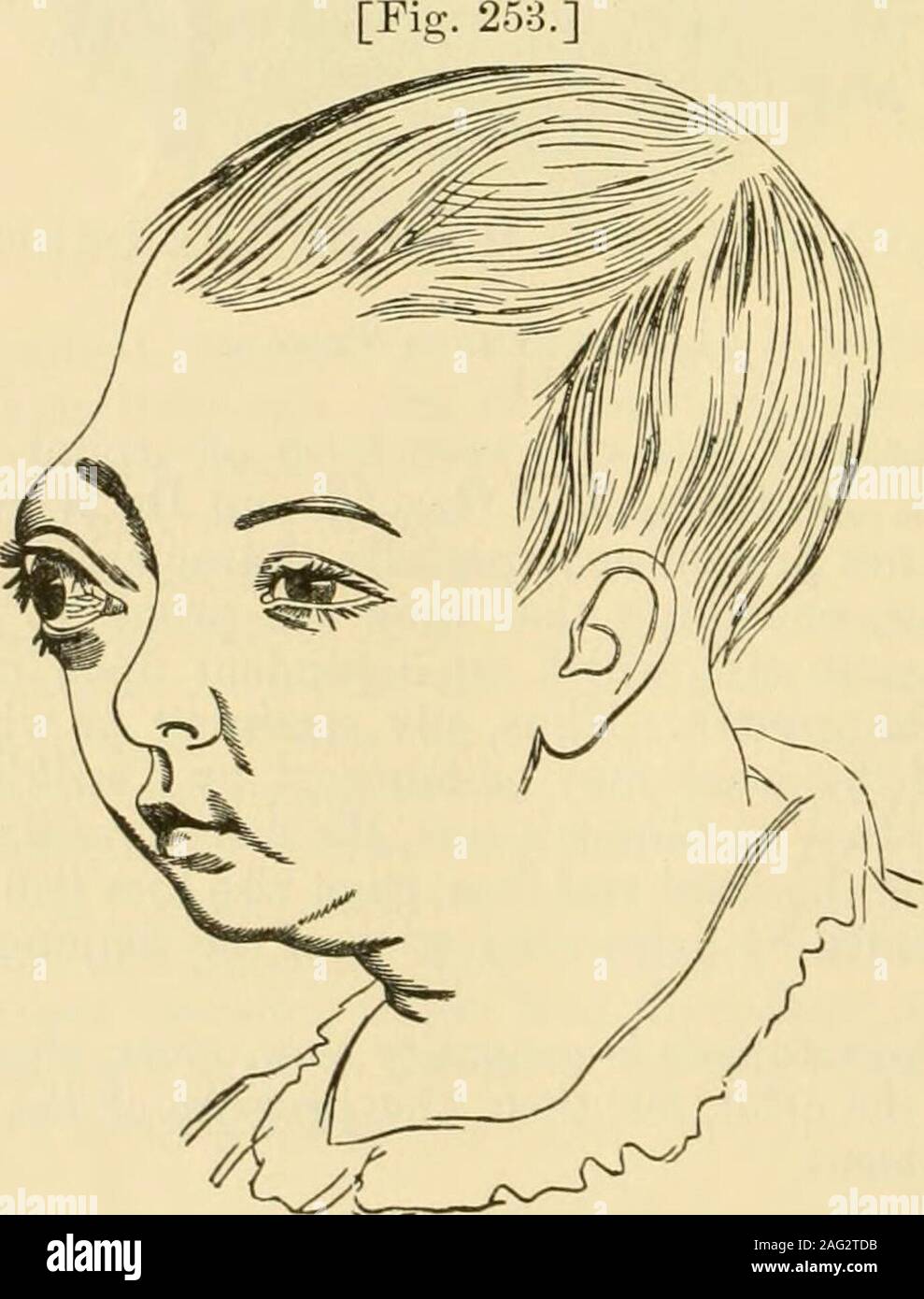 Exophthalmos hi-res stock photography and images - Alamy