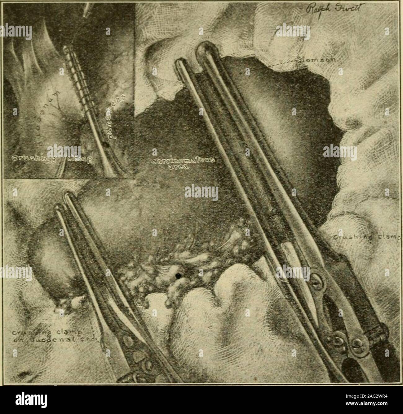 The omentum removed hi-res stock photography and images - Alamy