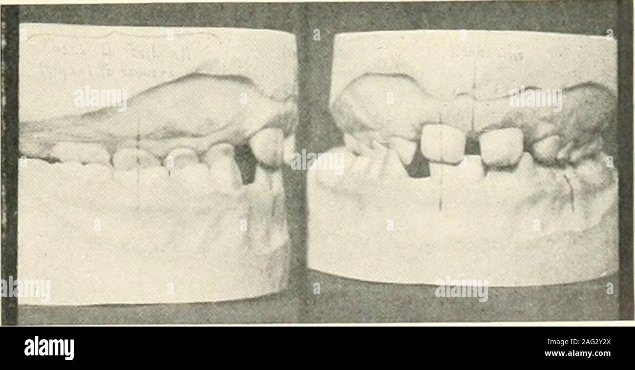 Dental spacing hi-res stock photography and images - Alamy