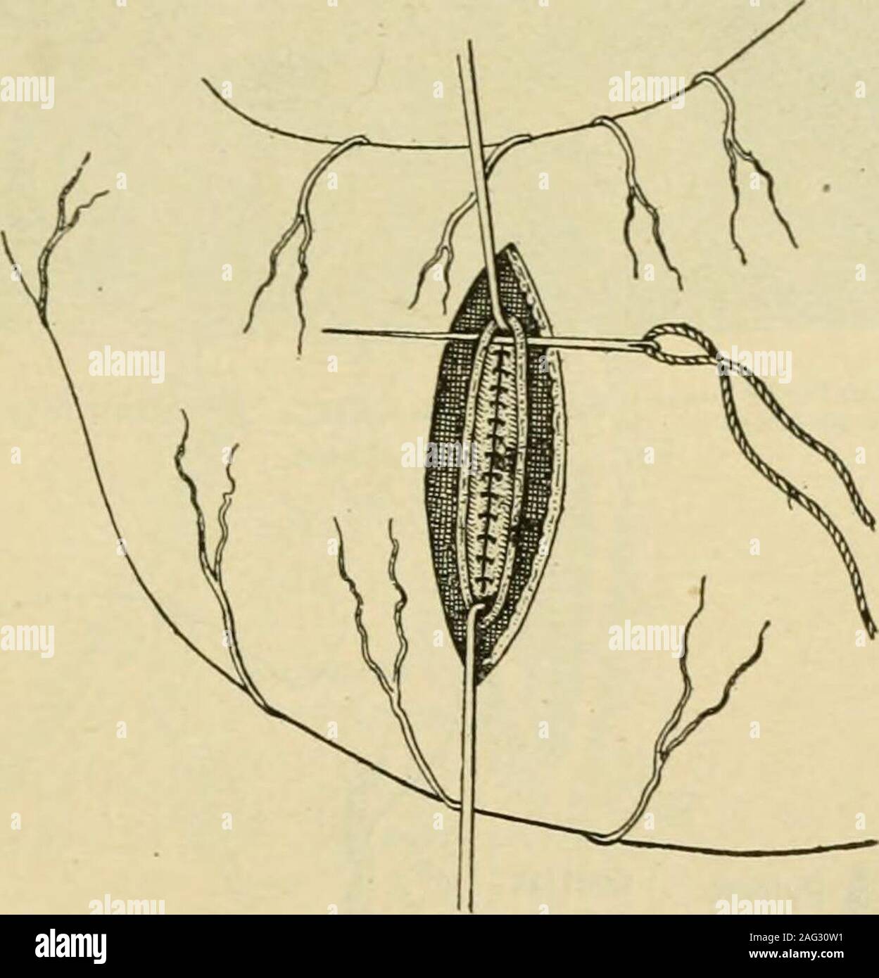 . Manual of operative surgery. is longer than that of the other, place ...