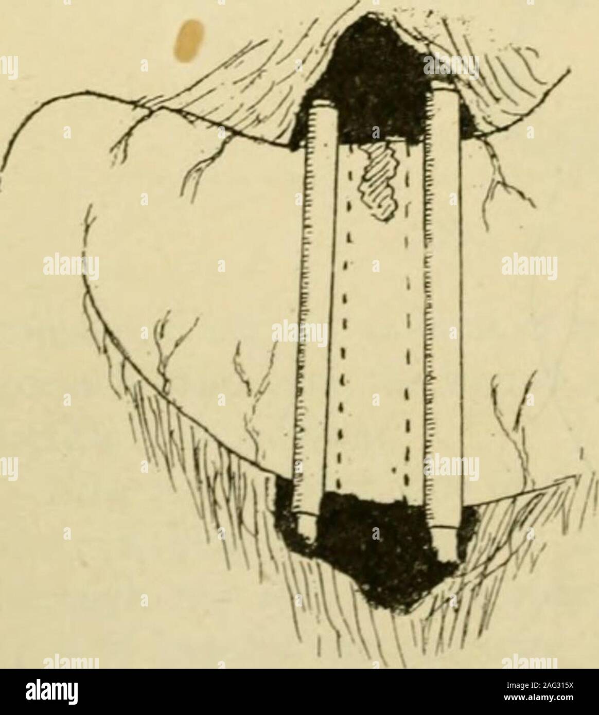 . Manual of operative surgery. ng axis of the stomach.Step 4.—Close the ...