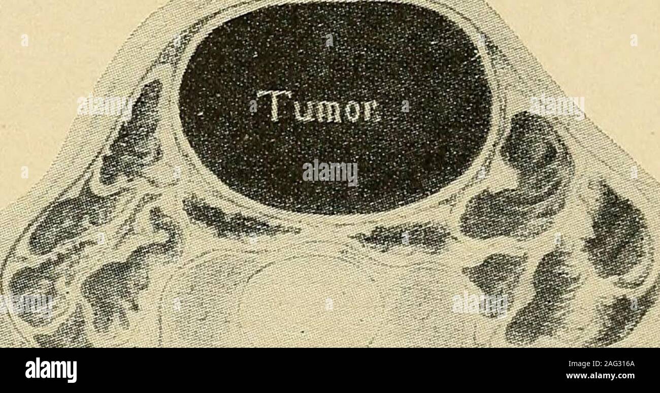 Peritoneal cavity fluid hi-res stock photography and images - Alamy