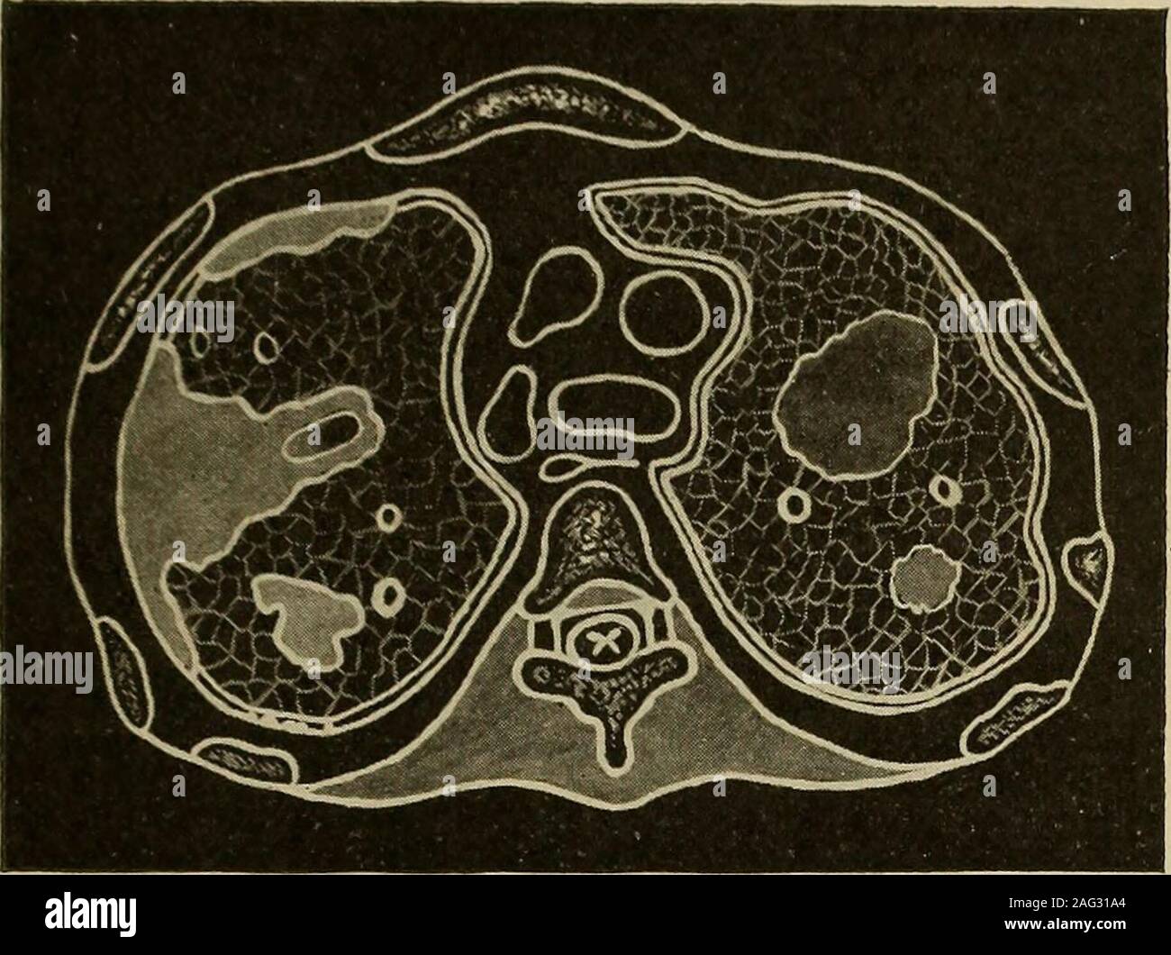 Lung cavitation hi-res stock photography and images - Alamy