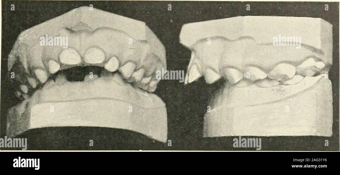 Occlusion abnormality hi-res stock photography and images - Alamy