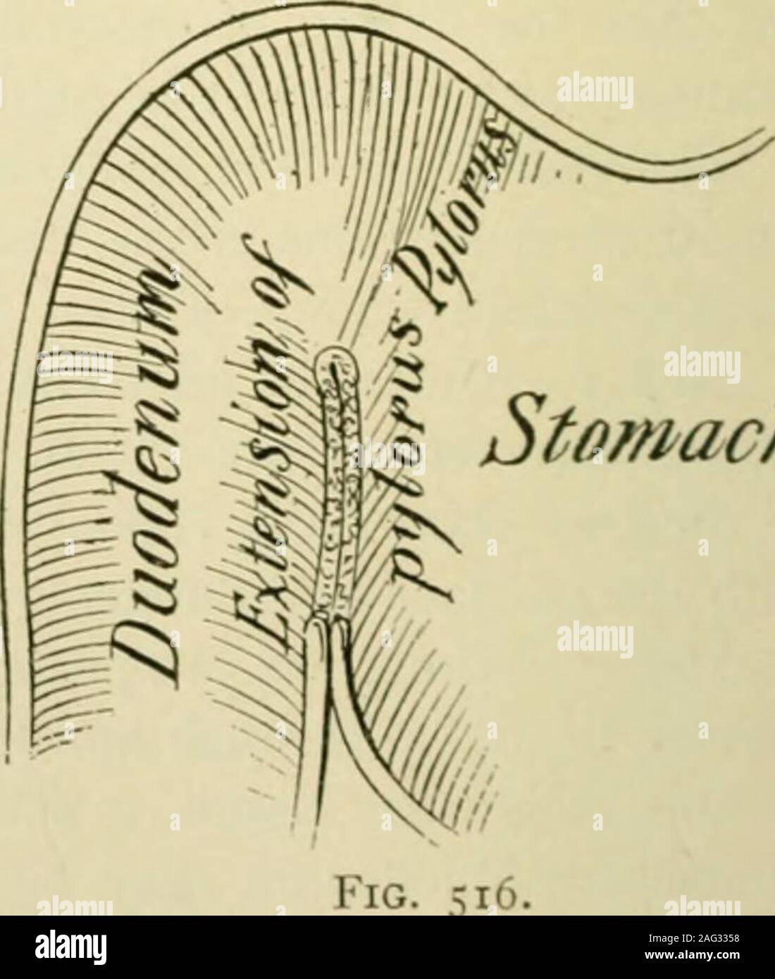 . Manual of operative surgery. Fig. 515. Figs. 515 and 516.—Finneys ...