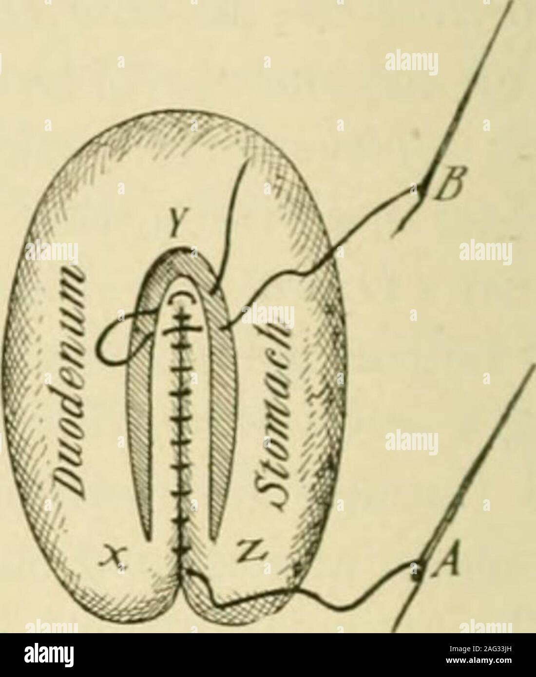 . Manual of operative surgery. Fig. 513. Fig. su- Figs. 513 and 514 ...