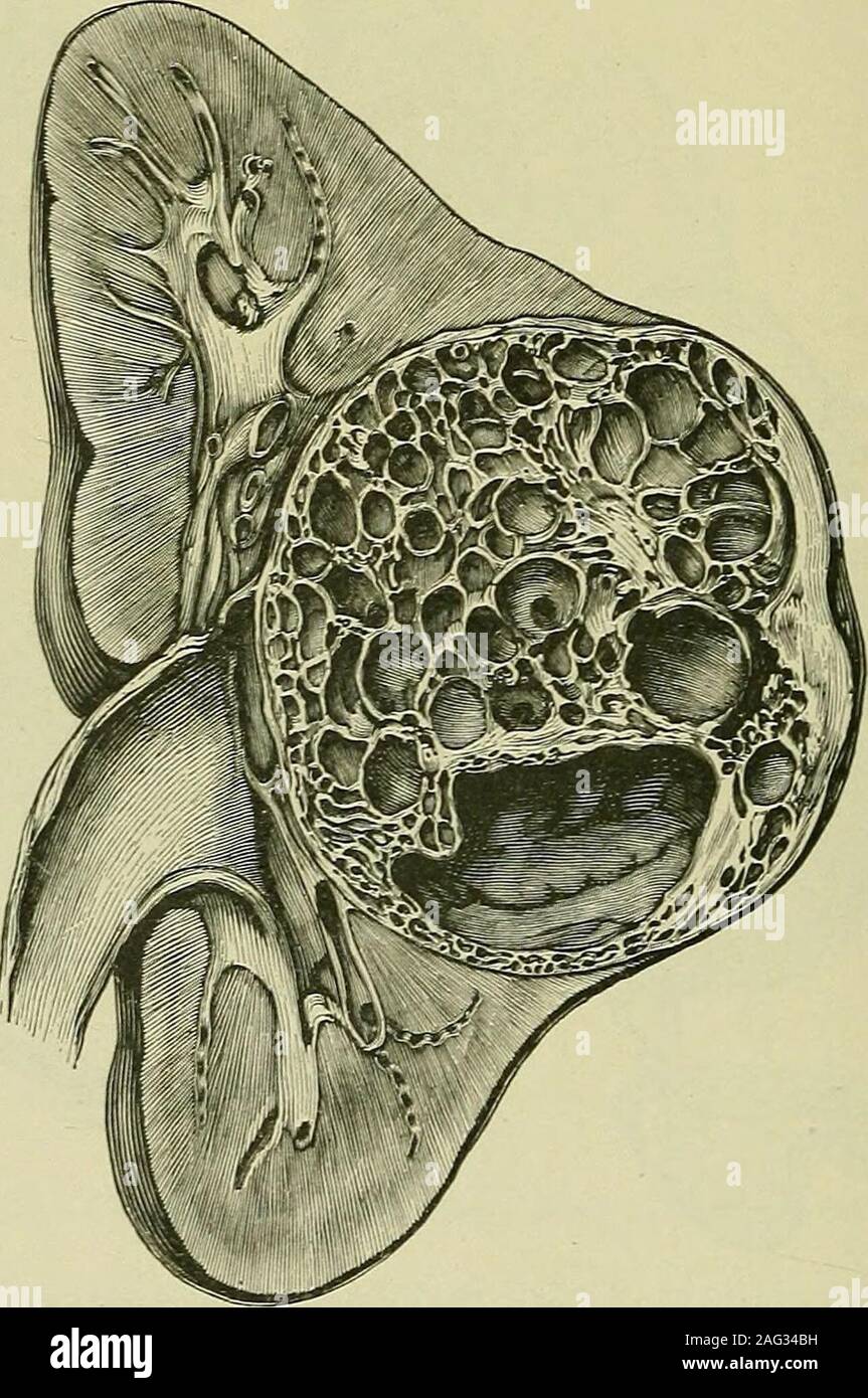 Large cysts hi-res stock photography and images - Alamy