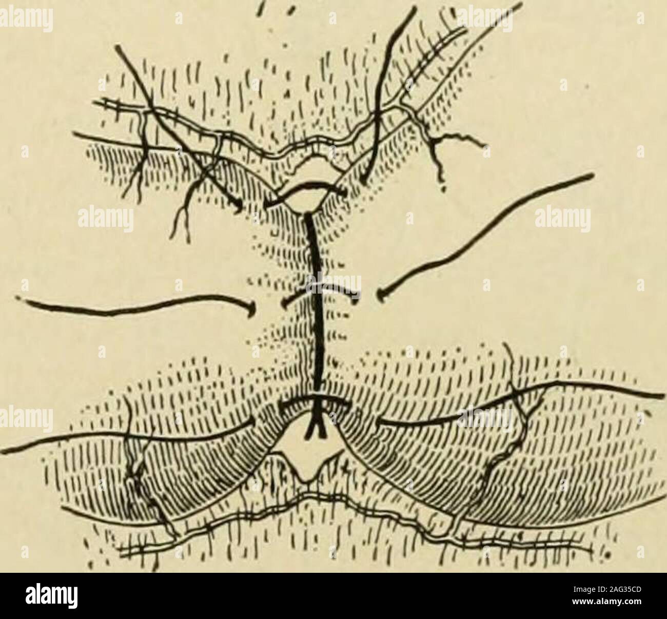 . Manual of operative surgery. Fig. 494.—Bartletts method. Fig. 495 ...