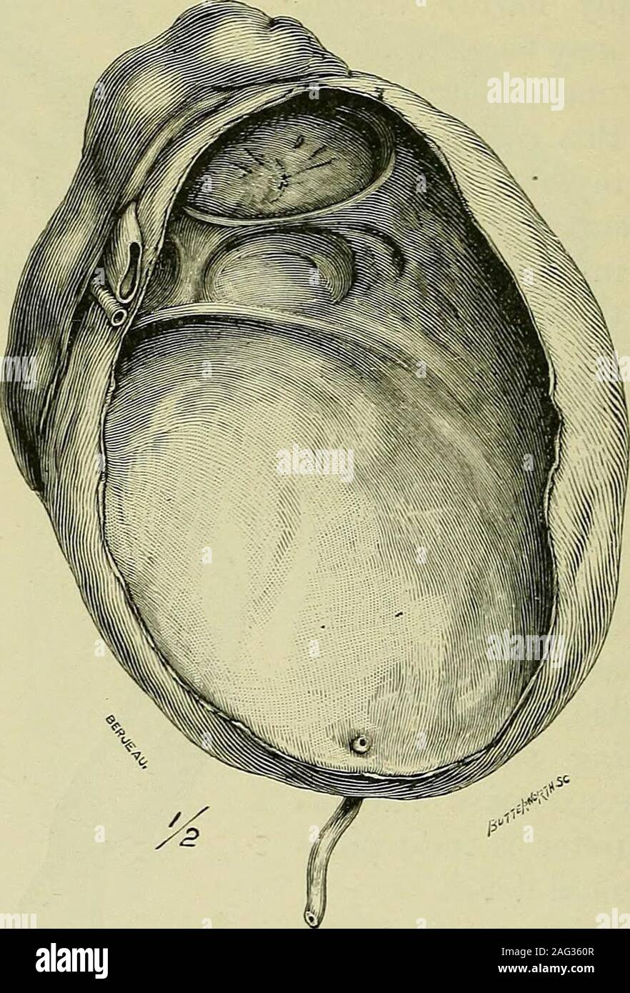 Renal cysts hi-res stock photography and images - Alamy