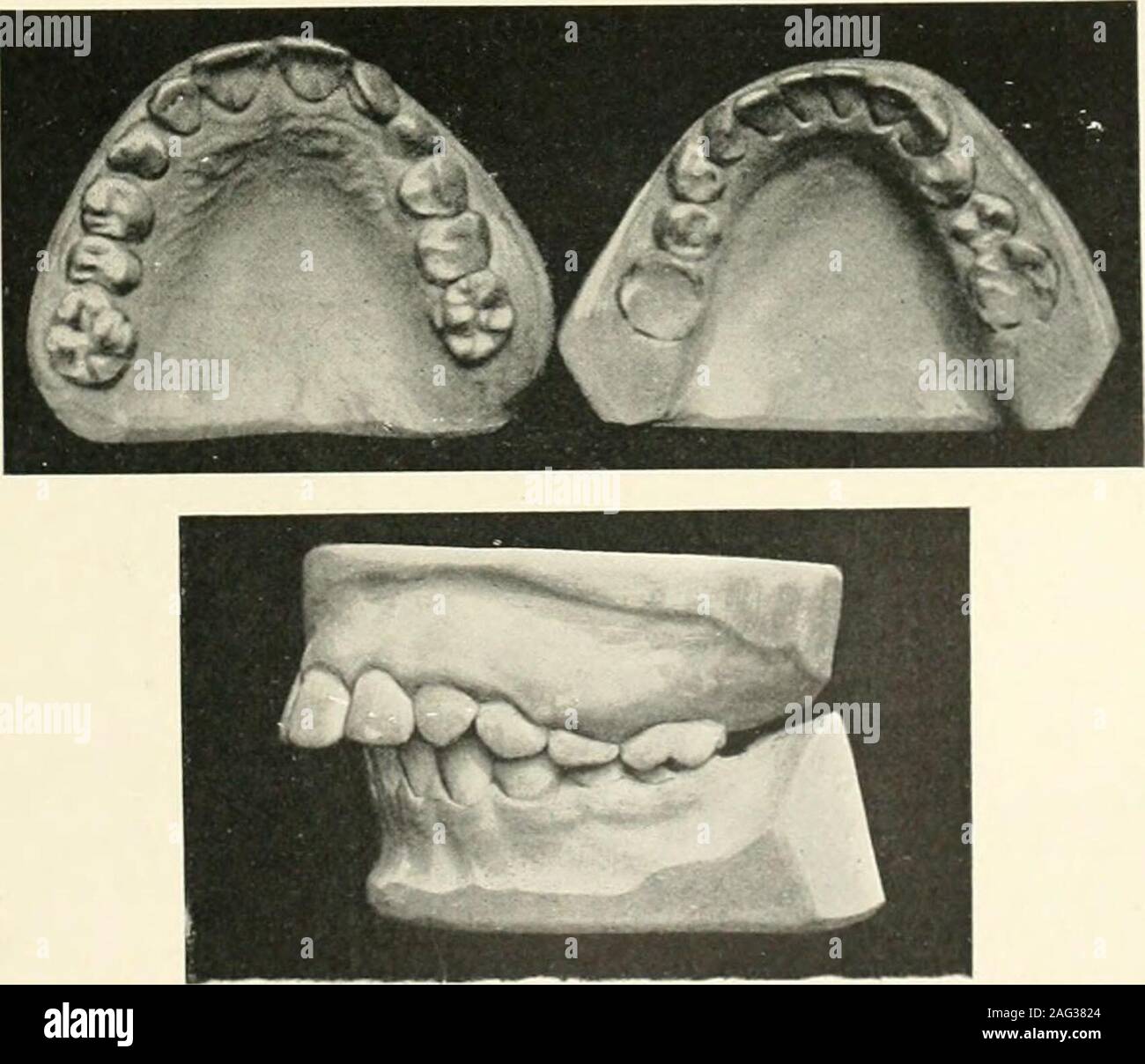 . The science and practice of dental surgery. 207.—Inferior retrusion ...