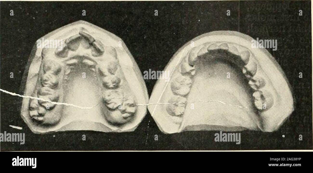 Molars erupting hi-res stock photography and images - Alamy