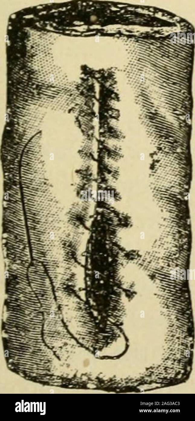 . Manual of operative surgery. s results in the rolling in of the ...